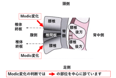 腰痛の原因？MRI画像診断 Modic（モディック）変化について - いとうペインクリニックブログ